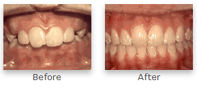 Common Treatments - Dr. Mike Mizell Orthodontist