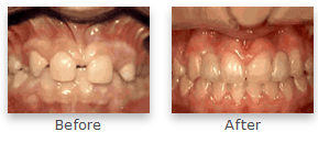 Common Treatments - Dr. Mike Mizell Orthodontist